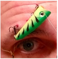 fishing accident injury near eye - ClearHealthCosts